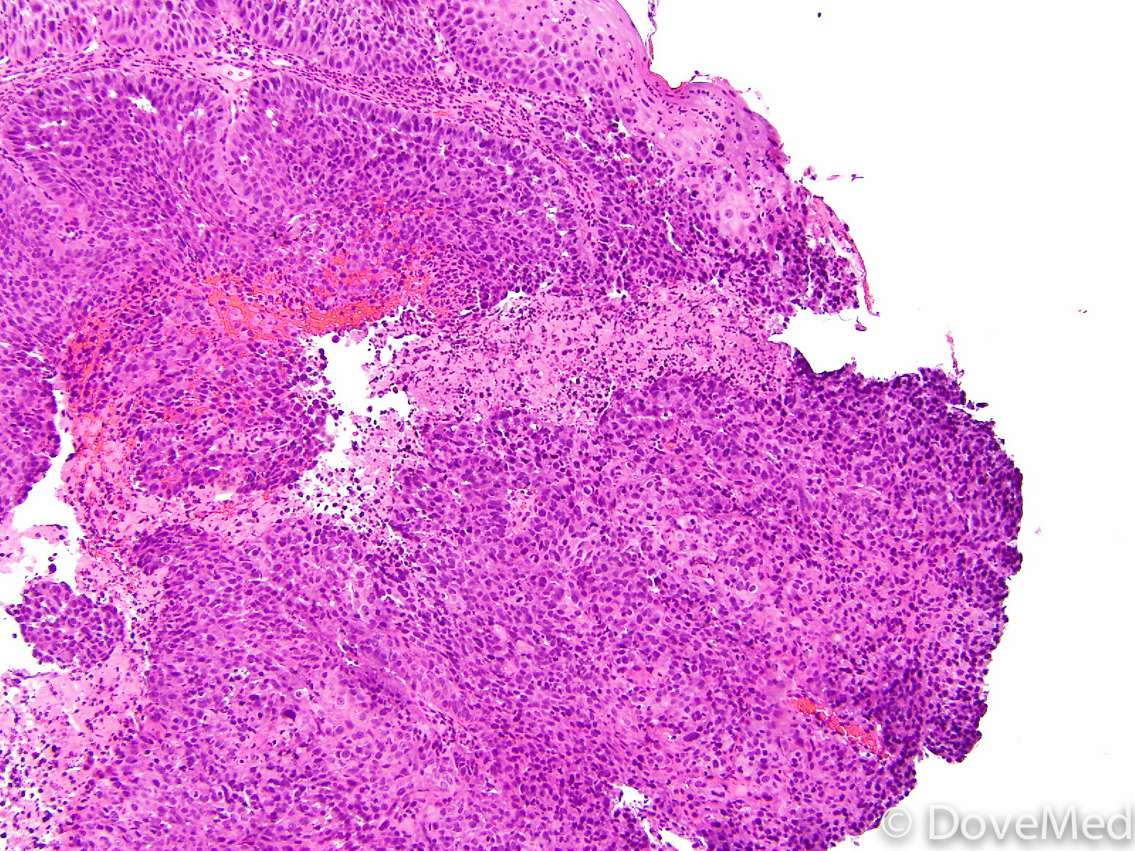 Invasive Squamous Cell Carcinoma of Penis