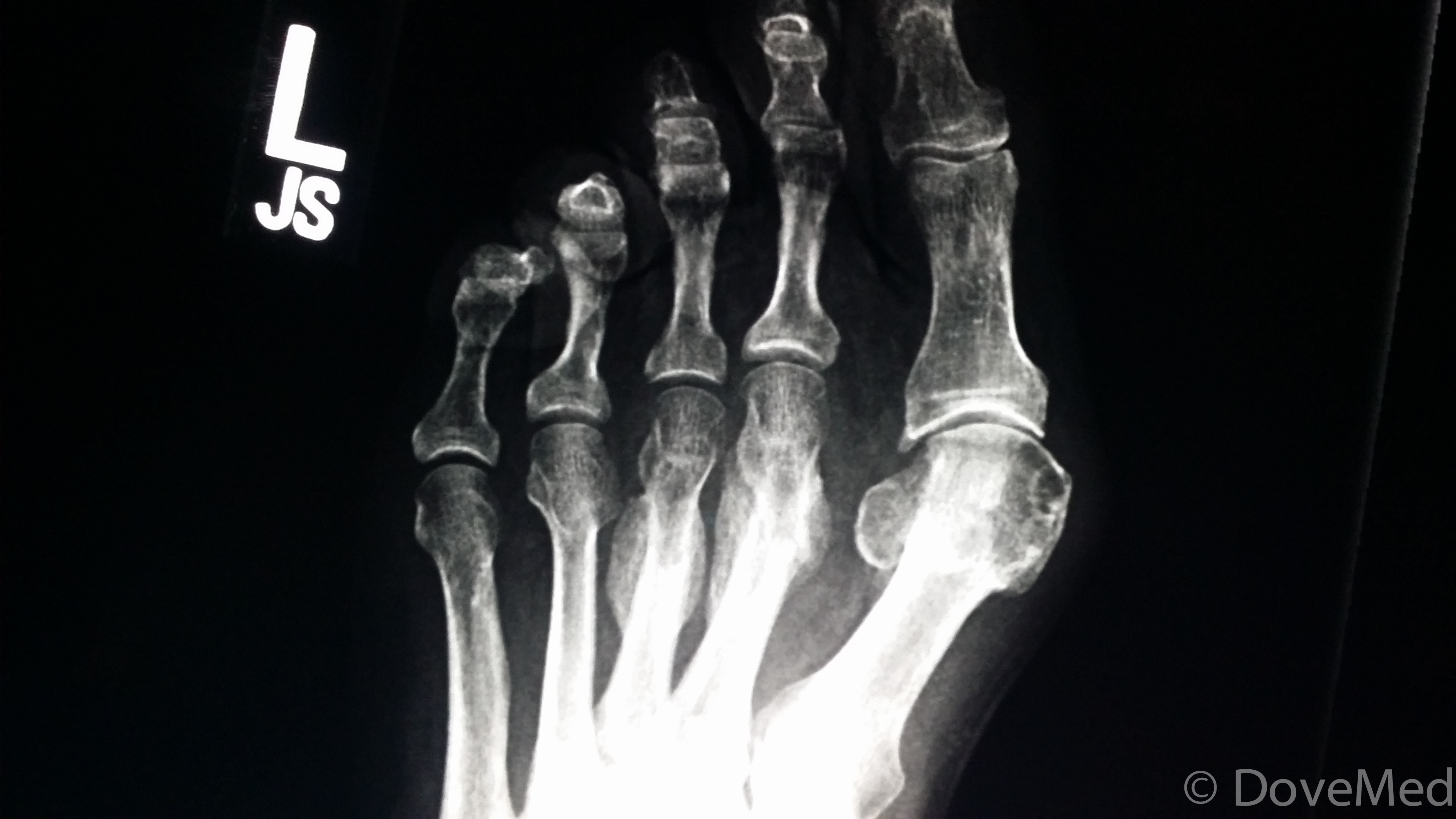 Stress Fracture
