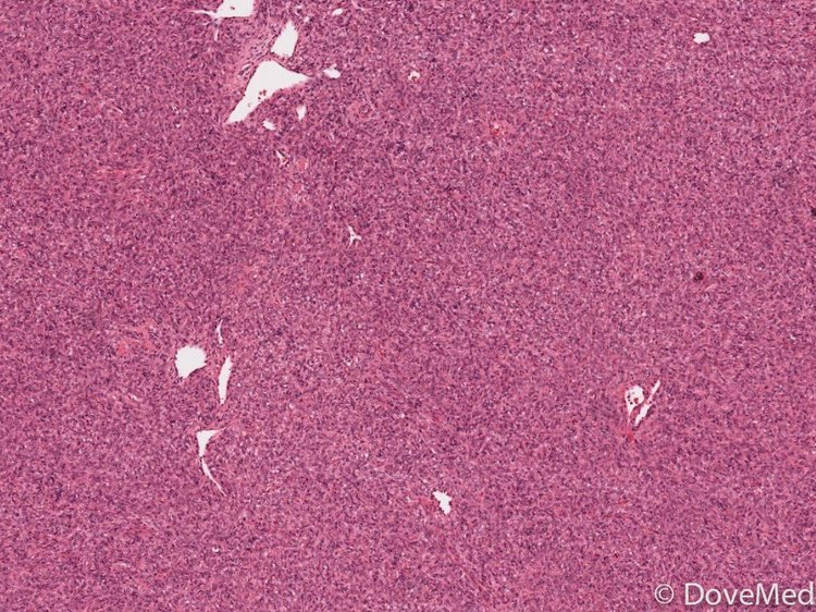 Solitary Fibrous Tumor of Ventricles of the Brain
