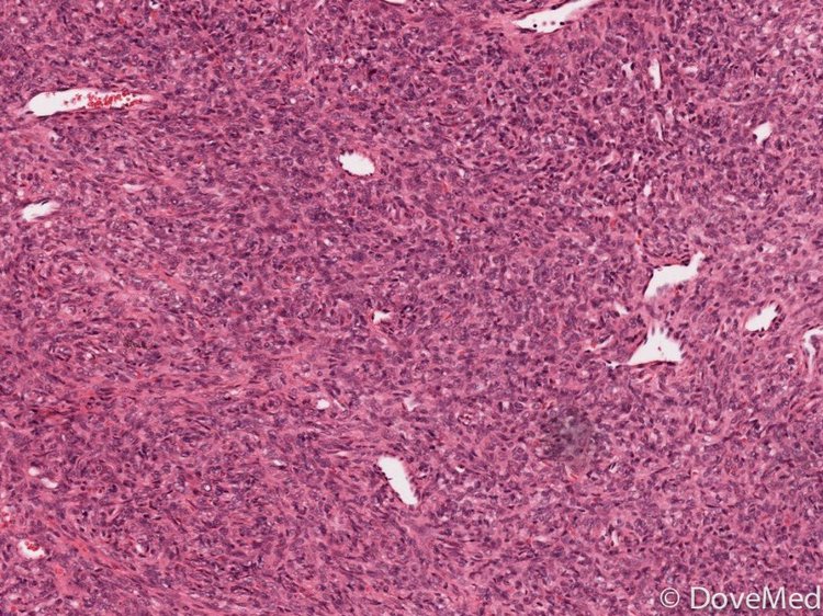 Solitary Fibrous Tumor of Urinary Bladder