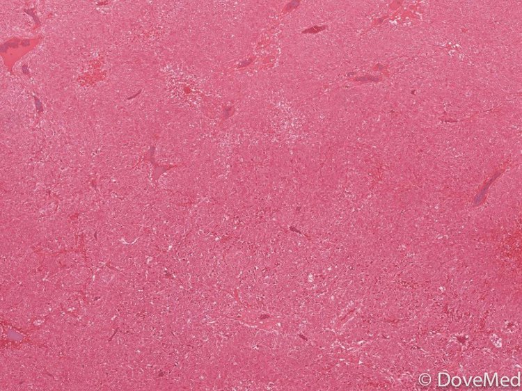 Solitary Fibrous Tumor of Soft Tissue
