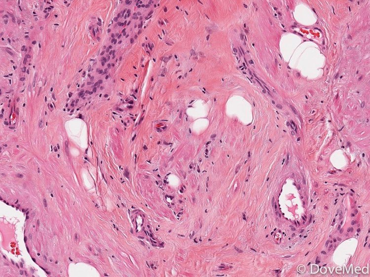 Angiomyolipoma of Liver