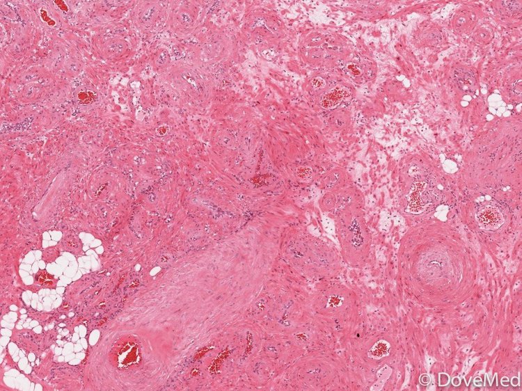 Angiomyolipoma of Uterine Cervix