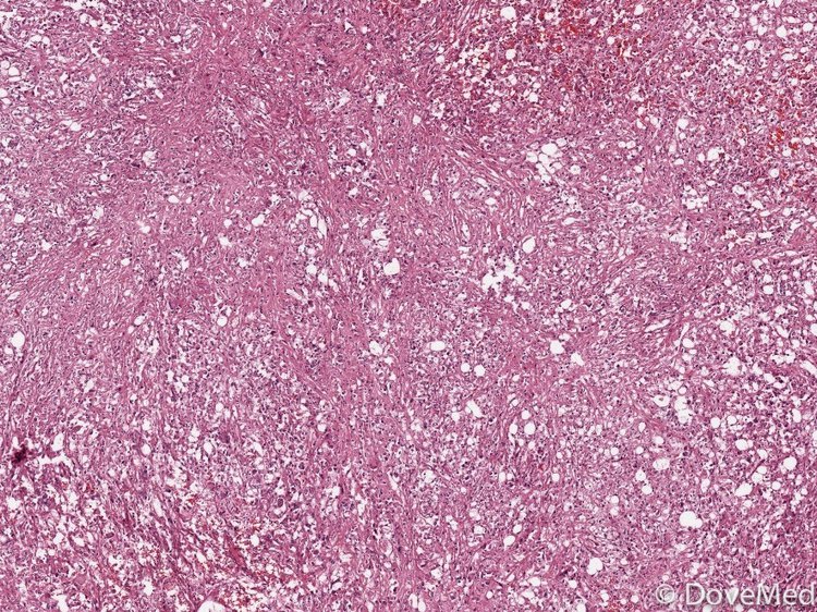 Angiomyolipoma of Heart