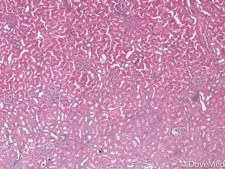 Angiomyolipoma of Uterus