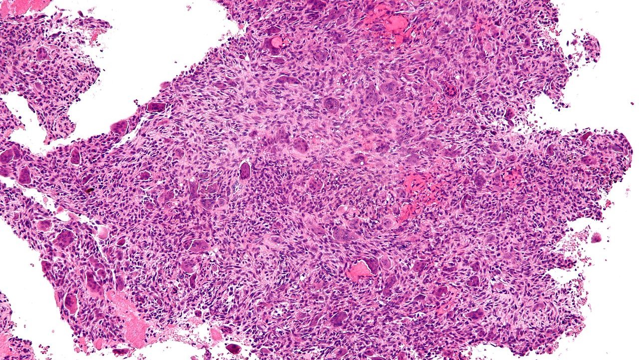 How well do you know Aneurysmal Bone Cyst (ABC)