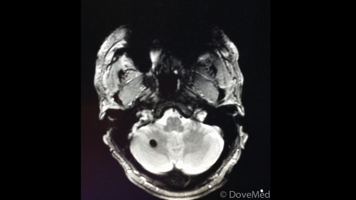 Cavernous Hemangioma