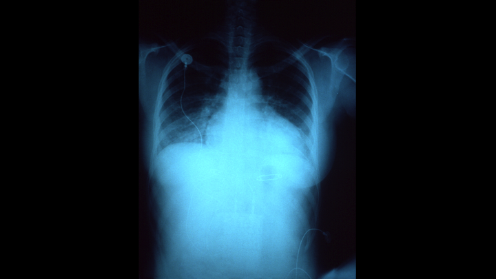 Congestive Heart Failure