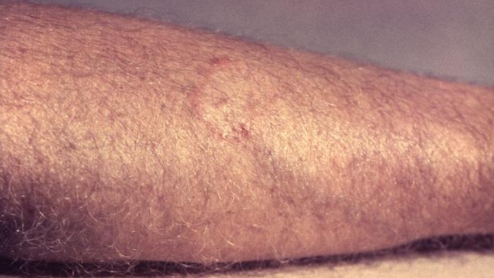 How well do you know Tinea Corporis Infection