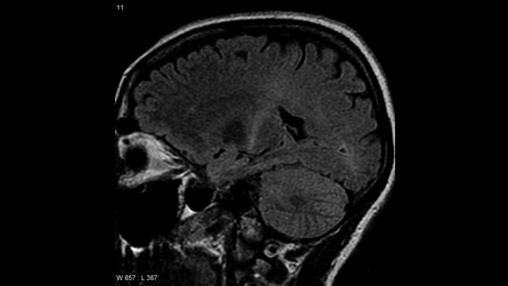 Amyotrophic Lateral Sclerosis (ALS)