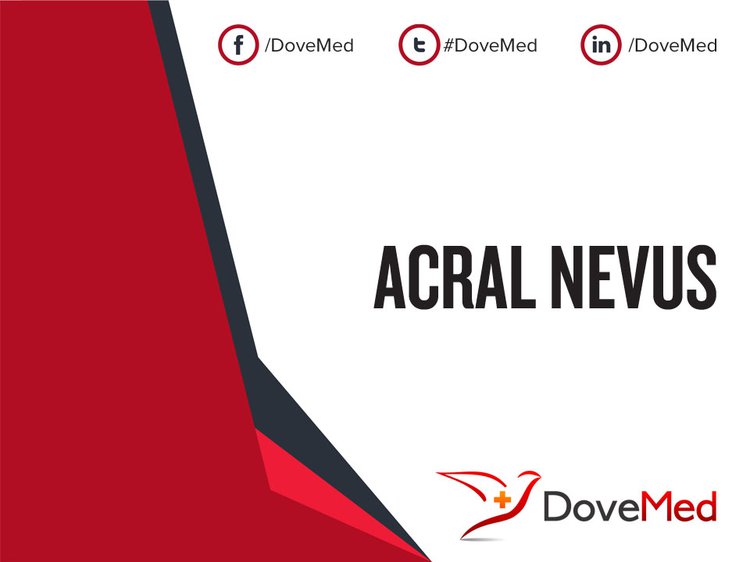 Acral Nevus