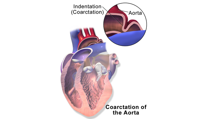 Coarctation of the Aorta (CoA)