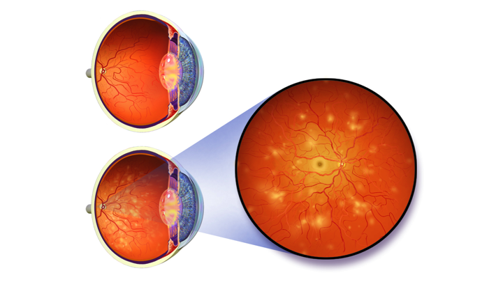 Hiv Retinopathy Symptoms