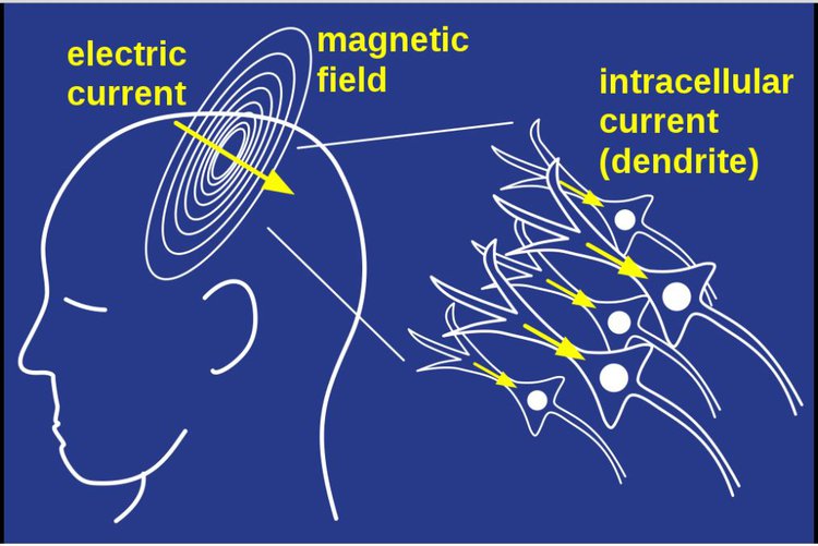 Magnetic Brain Waves To Detect Injury And Disease