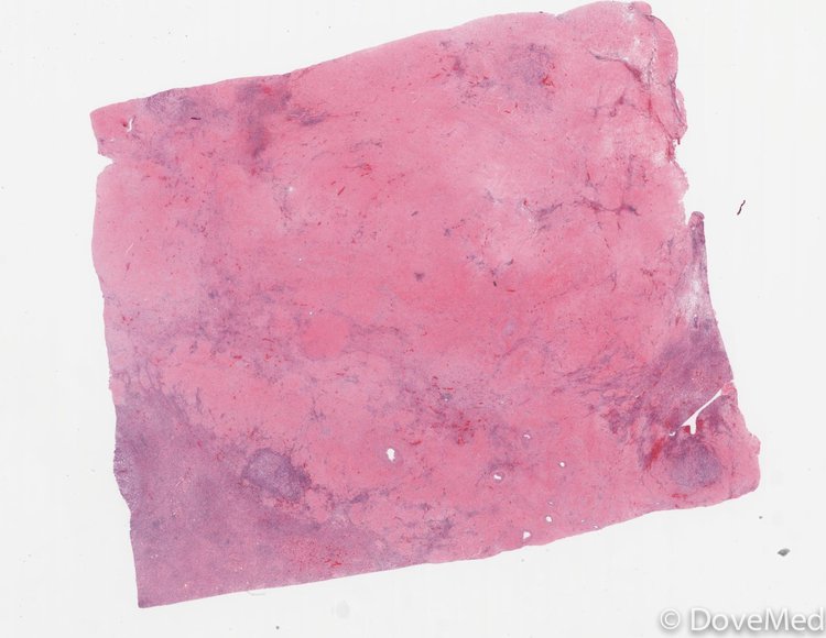 Collecting Duct Carcinoma of Kidney