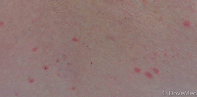 New Clues On The Historical Origin Of The Vaccine Used To Eradicate ...