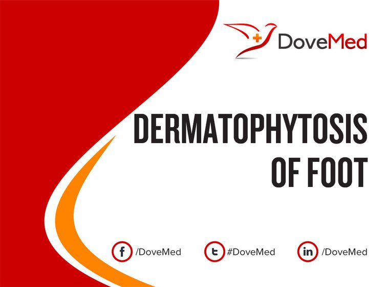 Dermatophytosis of Foot