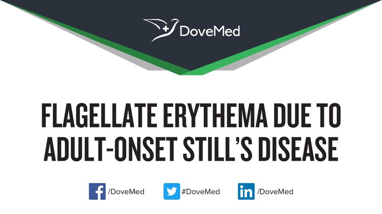 Flagellate Erythema due to Adult-Onset Still’s Disease