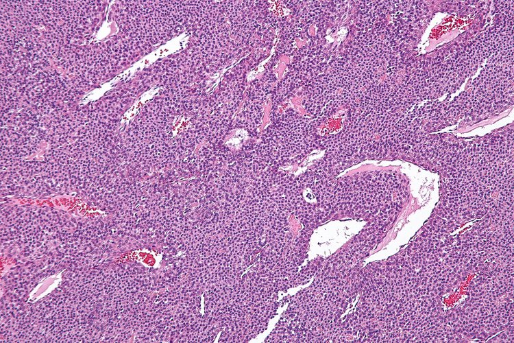 Benign Glomus Tumor