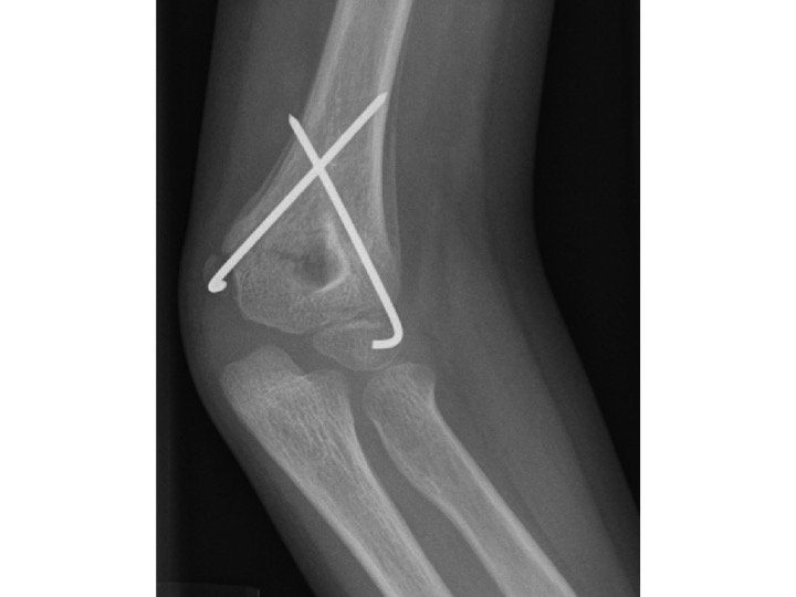 Elbow Fractures in Children