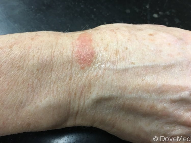 Scientists Devise New Way To Measure Skin Barrier Function Scientists Devise New Way To Measure Skin Barrier Function
