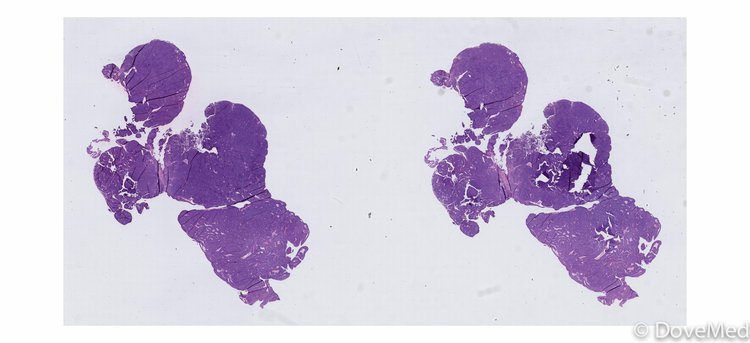 Inverted Urothelial Papilloma