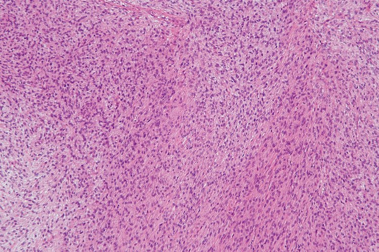 Low-Grade Fibromyxoid Sarcoma