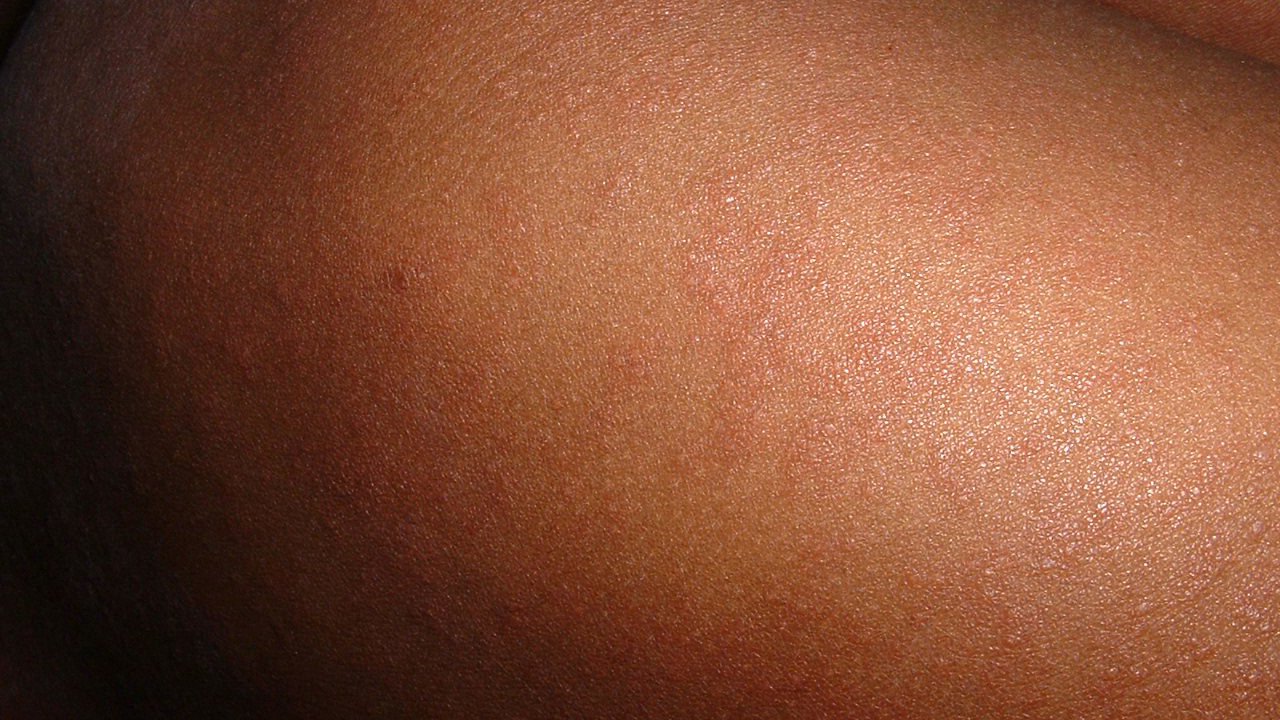 How well do you know Measles