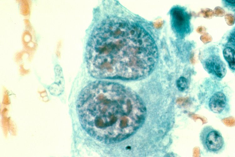 Conventional Osteosarcoma