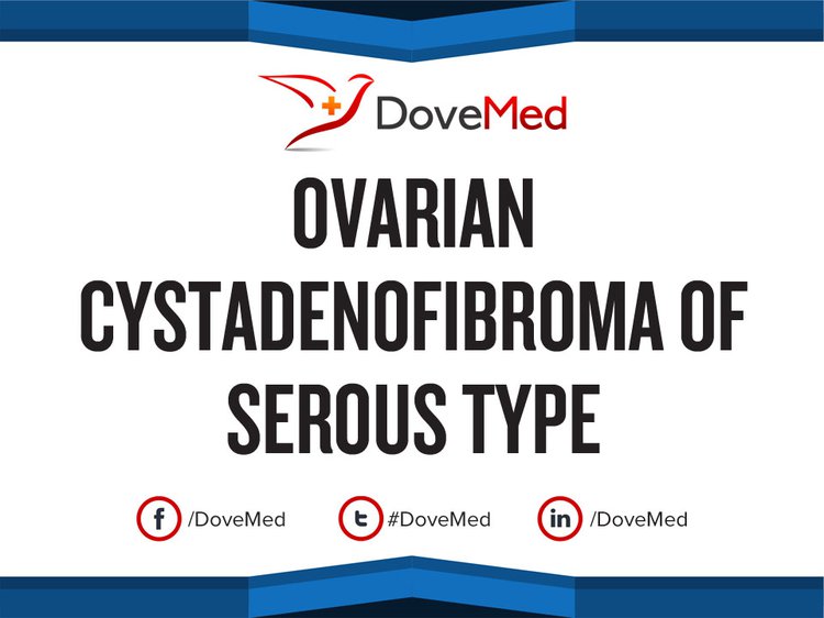 Ovarian Cystadenofibroma of Serous Type
