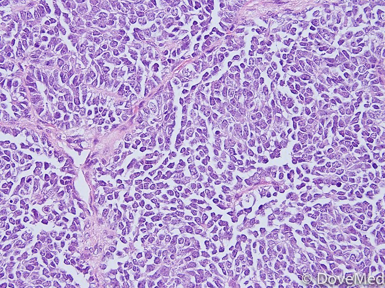 Wilms Tumor