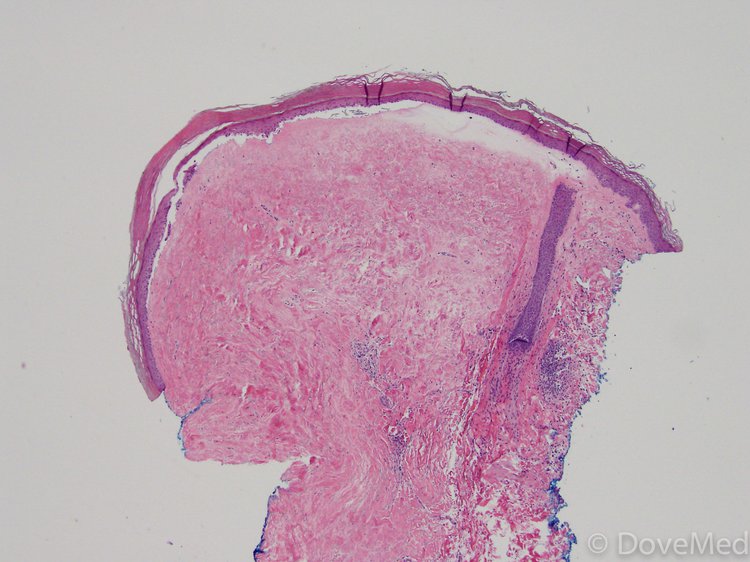 Lichen Sclerosus of Skin