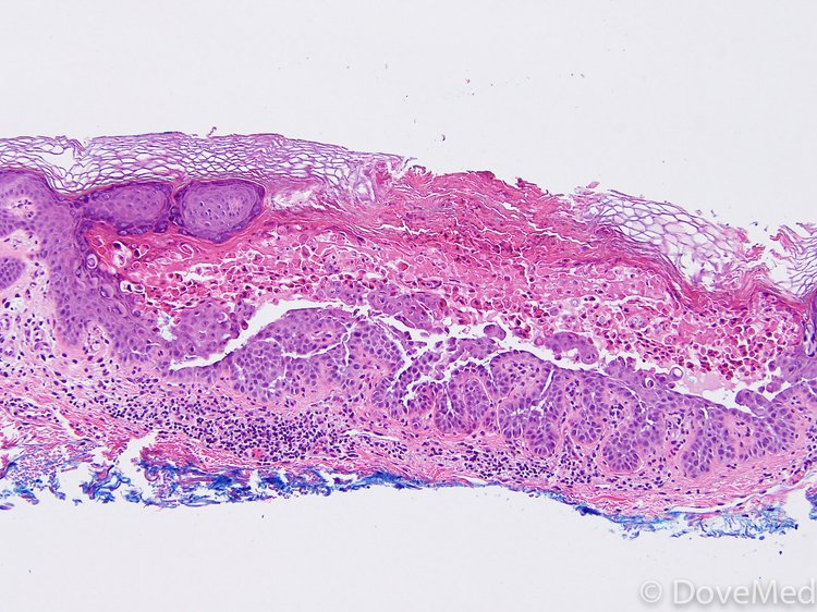 Grover's Disease