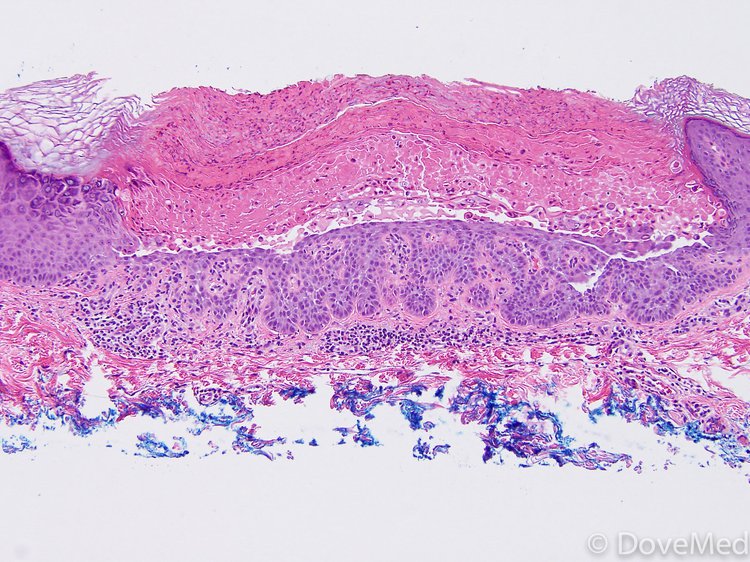 Persistent Acantholytic Dermatosis
