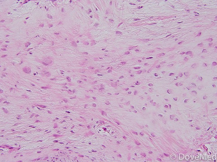 Synovial Chondromatosis