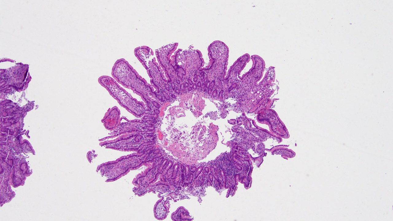 How well do you know Whipple’s Disease?