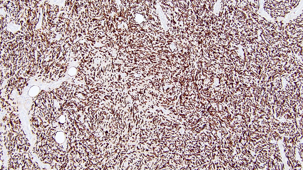 How well do you know Neurofibroma of Skin