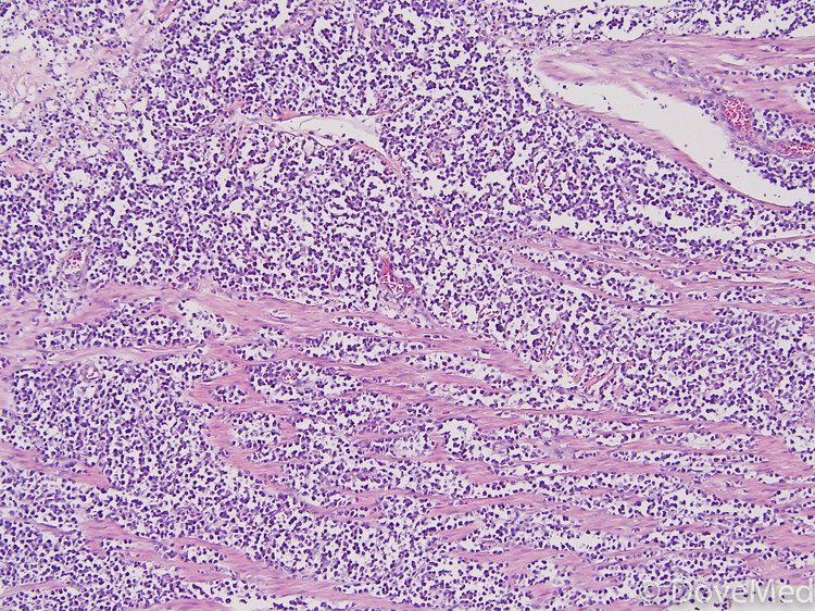 Burkitt Lymphoma of Small Intestine