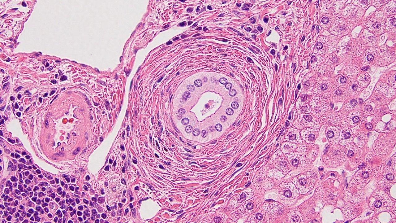 How well do you know Primary Sclerosing Cholangitis (PSC)