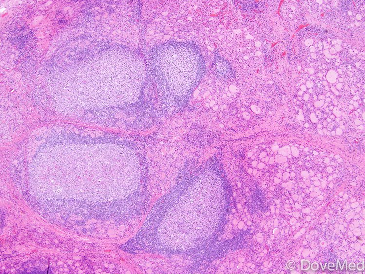 Autoimmune Thyroiditis