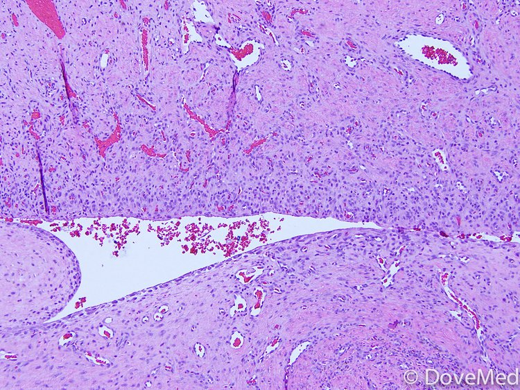 Angiofibroma of Skin