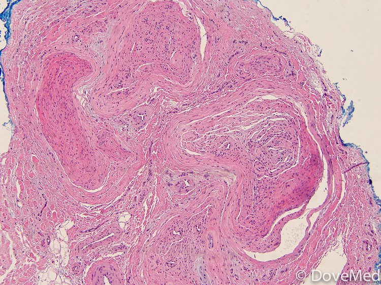 Traumatic Neuroma Pathology Outlines