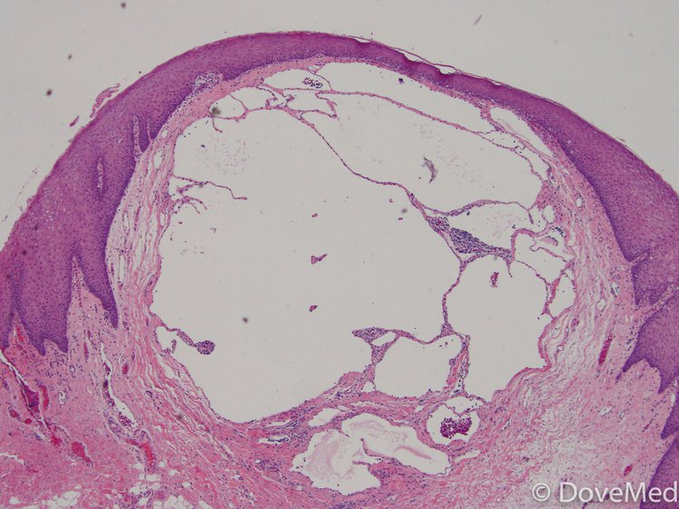 Progressive Lymphangioma of Skin