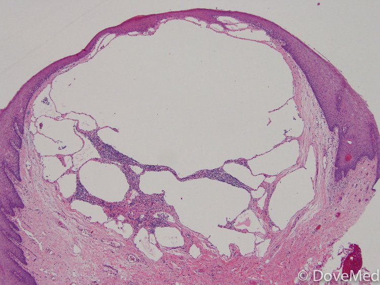 Oral Lymphangioma