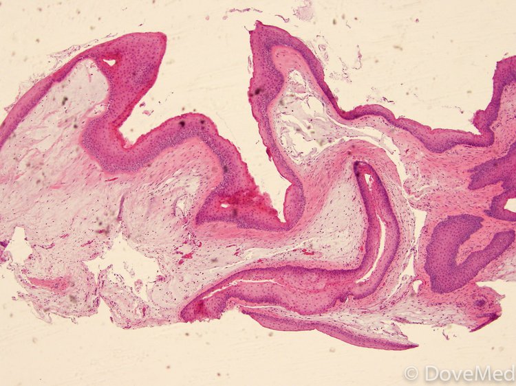 Vocal Cord Nodules