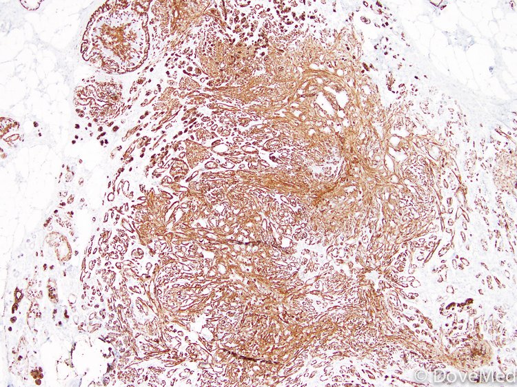 Sclerosing Adenosis Of Breast