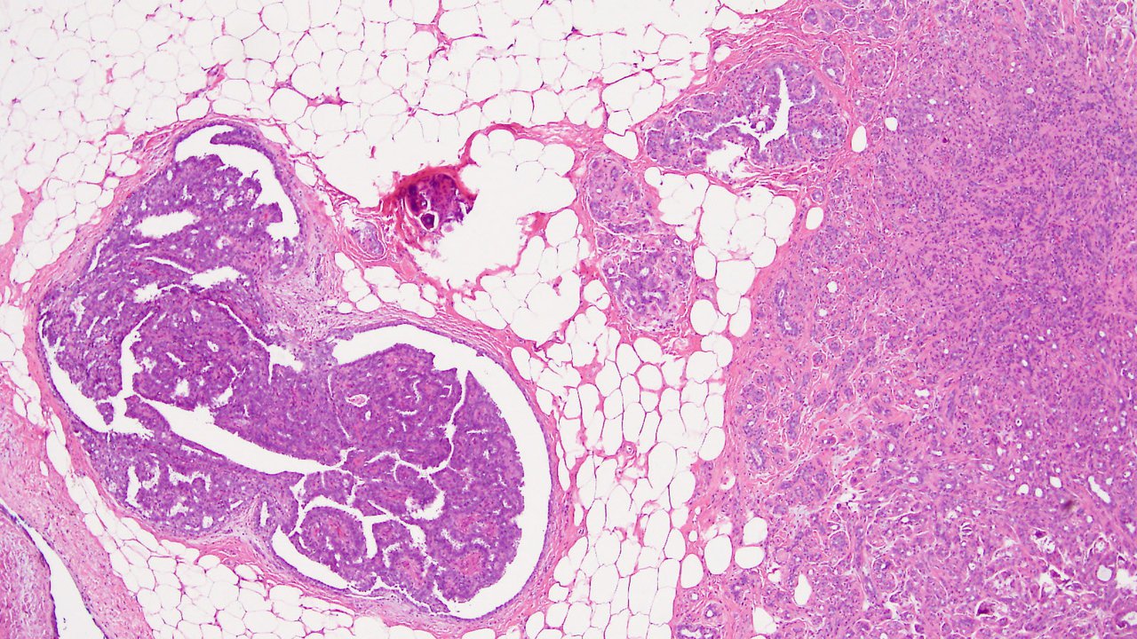 How well do you know Sclerosing Adenosis of Breast