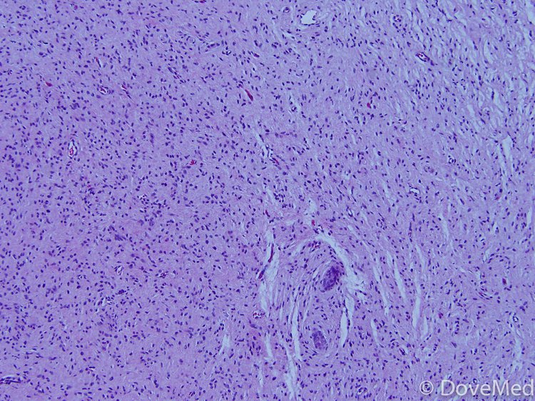 Neurotized Nevus