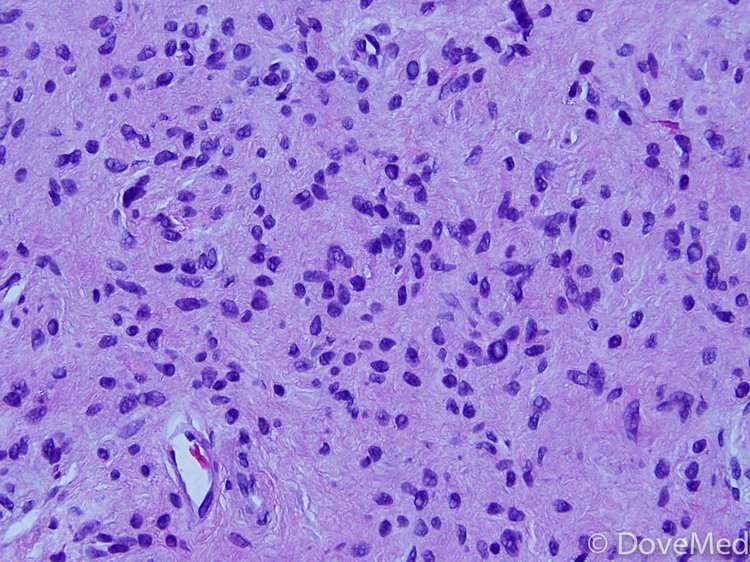 Neurotized Melanocytic Nevus