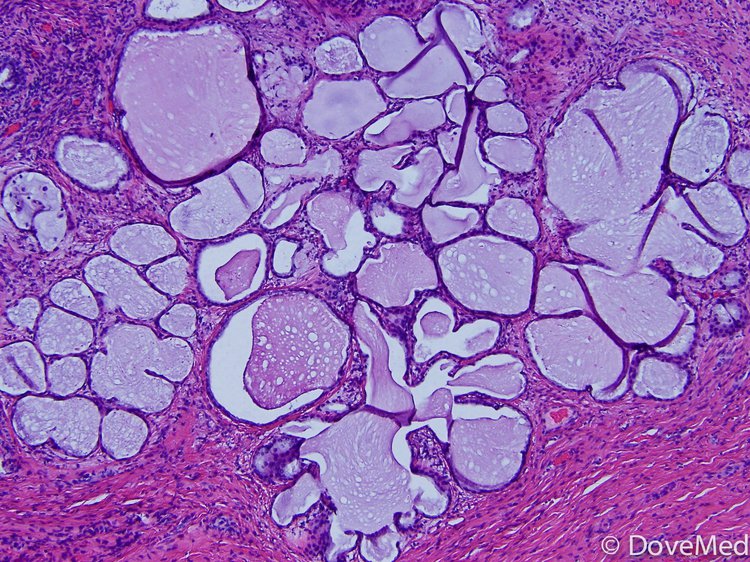 Tunnel Clusters of Uterine Cervix